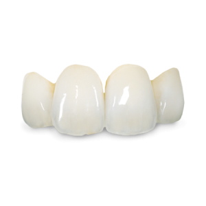 PMMA Temp – All American Dental Lab